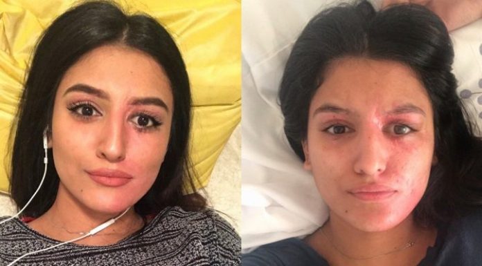 Kembali Cantik Selepas Bersolek Mangsa Simbahan Asid Ini Kongsi Foto