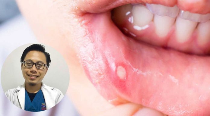 Bahaya Ulser Mulut Kalau Lebih Sebulan, Doktor ENT Ini Dedah Penyakit ...