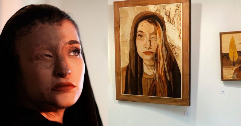 Inspirasi Kekuatan Di Sebalik Wajah Mangsa Simbahan Asid, Marzieh ...