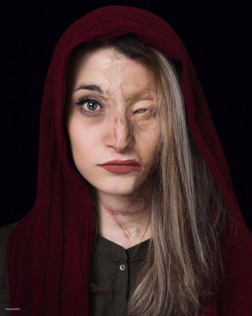 Inspirasi Kekuatan Di Sebalik Wajah Mangsa Simbahan Asid, Marzieh ...