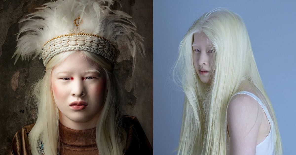 Kisah Xueli Abbing, Gadis Albino Yang Terbuang Namun Kini Model Berjaya!